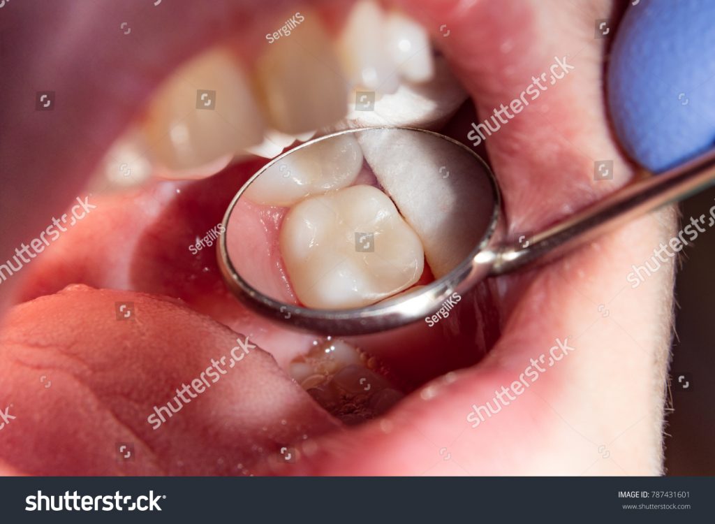 stock-photo-two-chewing-side-teeth-of-the-upper-jaw-after-treatment-of ...