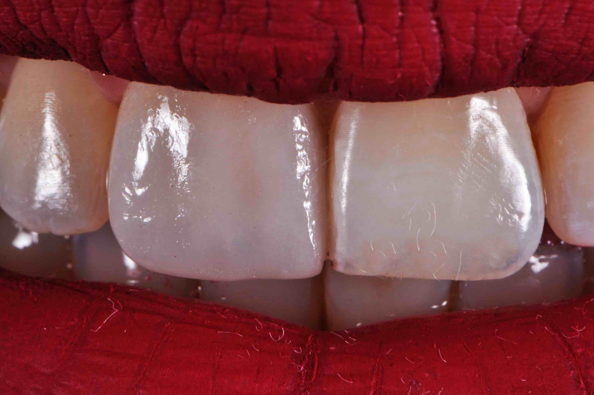 Dental veneers | Dr. Gallone | Lingual Orthodontics Catania