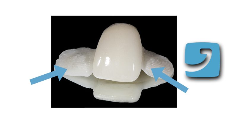 ponte adesivo in ceramica.001 - Dr. Gallone - Specialista dell ...